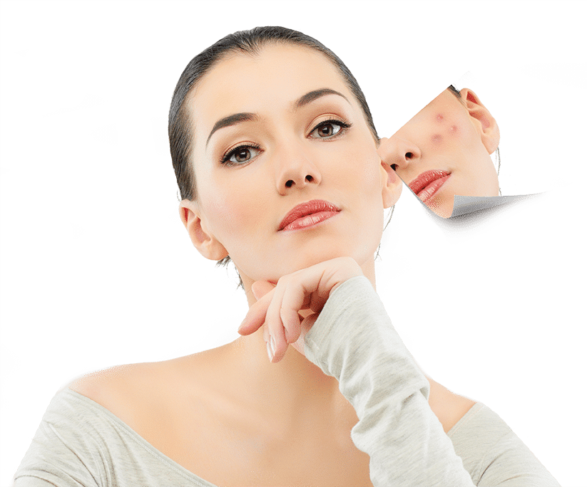 Anti Acne Facial treatment Milada Medical Spa Nuns Island Verdun